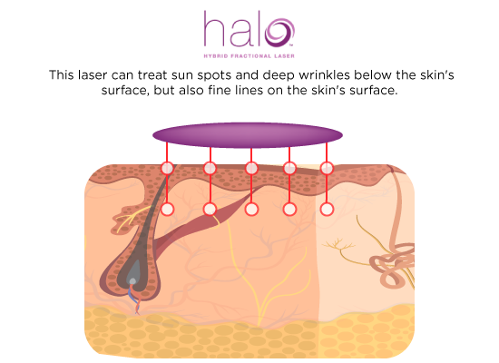 Best Procedures For 30's: Halo® By Sciton - Acqua Blu Medical Spa