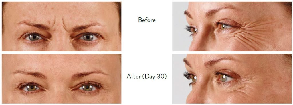 3 Things You Need to Know About Getting Injectables for the First Time ...