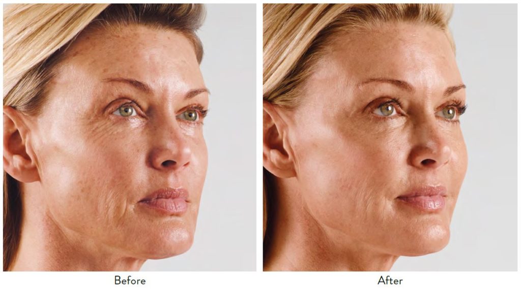 3 Things You Need to Know About Getting Injectables for the First Time ...