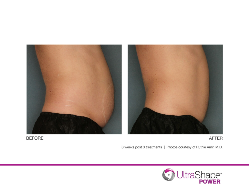 Now Providing UltraShape Power™: The Latest in Body Contouring ...